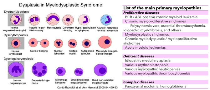 Clase digital 10. Myelodysplastic syndromes - Recursos Educativos Abiertos