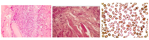 Clase digital 11. Myeloproliferative syndromes - Recursos Educativos ...