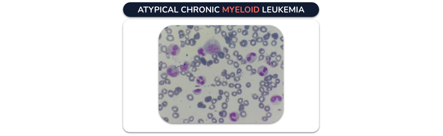 Digital class 10. Myelodysplastic syndromes - Recursos Educativos Abiertos