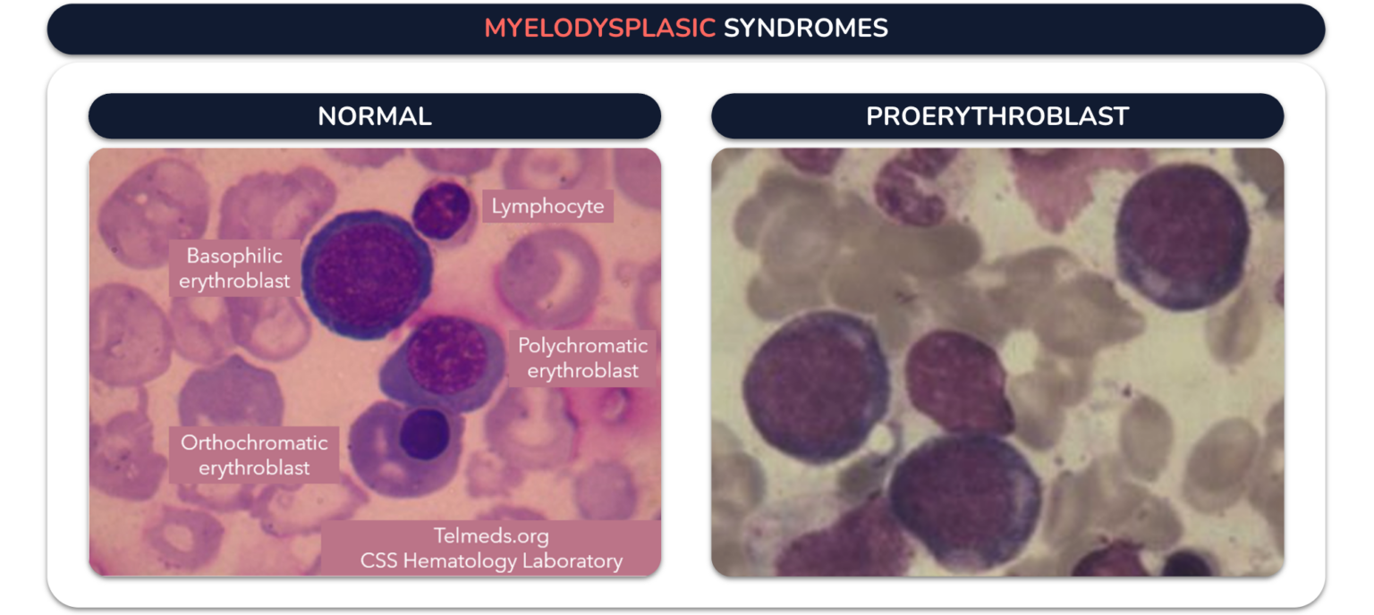 Digital class 10. Myelodysplastic syndromes - Recursos Educativos Abiertos