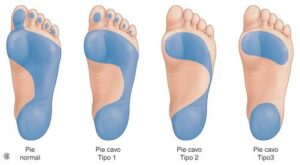 Clase digital 2. Pie plano y cavo - Recursos Educativos Abiertos